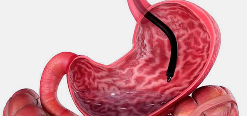 Endoscopia Digestiva Alta